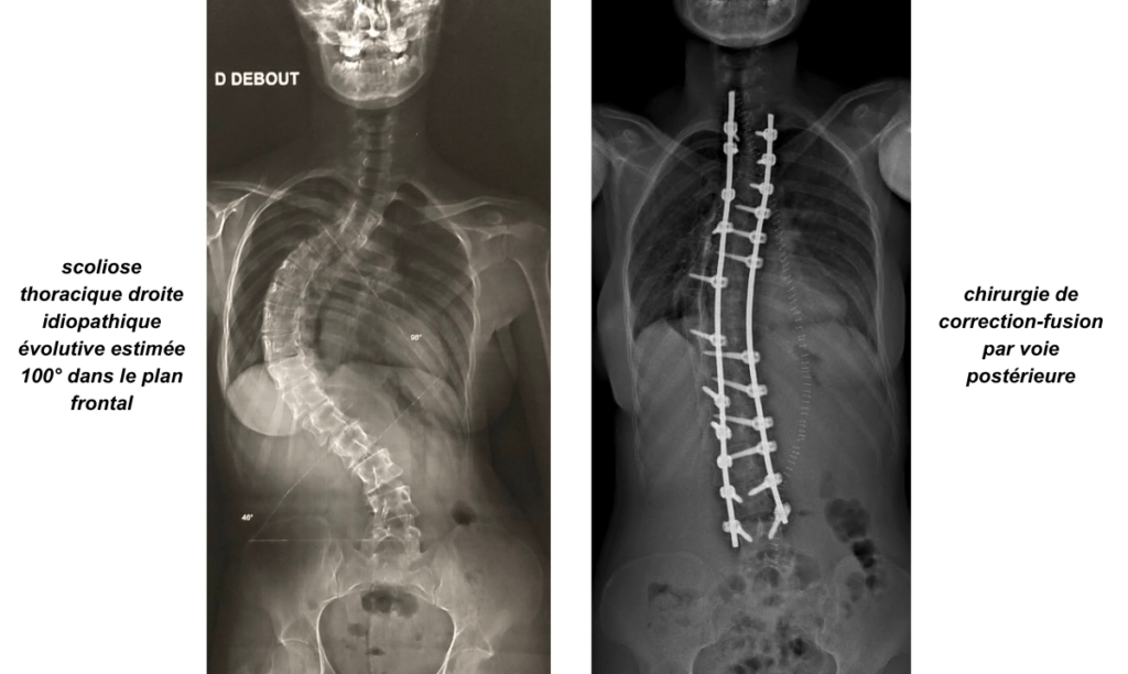 Chirurgie de scoliose : Procédure, Risques et Convalescence